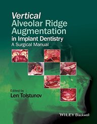 Buy Vertical Augmentation of the Alveolar Ridge in Implant Dentistry ...